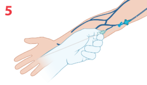 PICCとは？PICCの基本知識と安全な取り扱い方法・看護のポイント | カーディナルヘルス医療関係者向け製品情報サイト