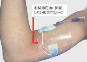 PICCとは？PICCの基本知識と安全な取り扱い方法・看護のポイント | カーディナルヘルス医療関係者向け製品情報サイト